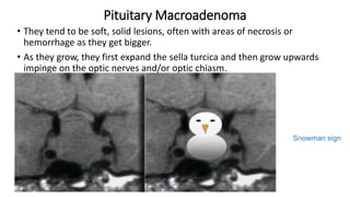 sellar and suprasellar mass pituitary gland .pptx