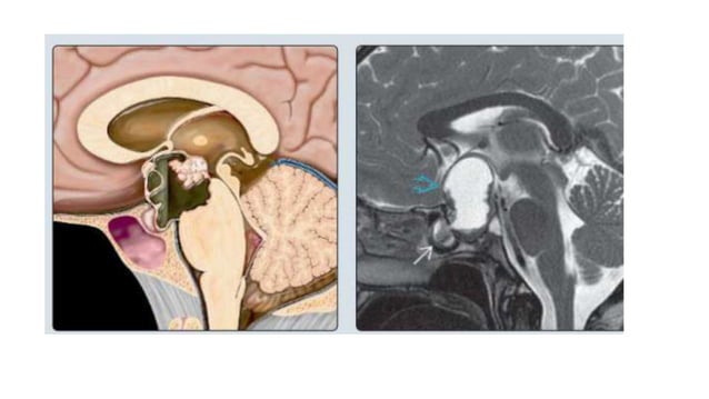 sellar and suprasellar mass pituitary gland .pptx | Endocrine and ...