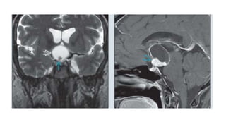 sellar and suprasellar mass pituitary gland .pptx
