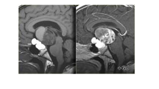 sellar and suprasellar mass pituitary gland .pptx