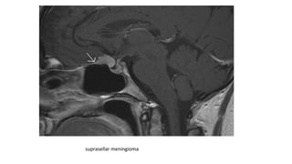 sellar and suprasellar mass pituitary gland .pptx