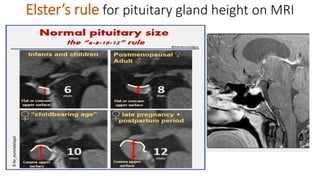 sellar and suprasellar mass pituitary gland .pptx | Endocrine and ...