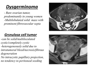 Sellar mass and ovarian mass | PPT