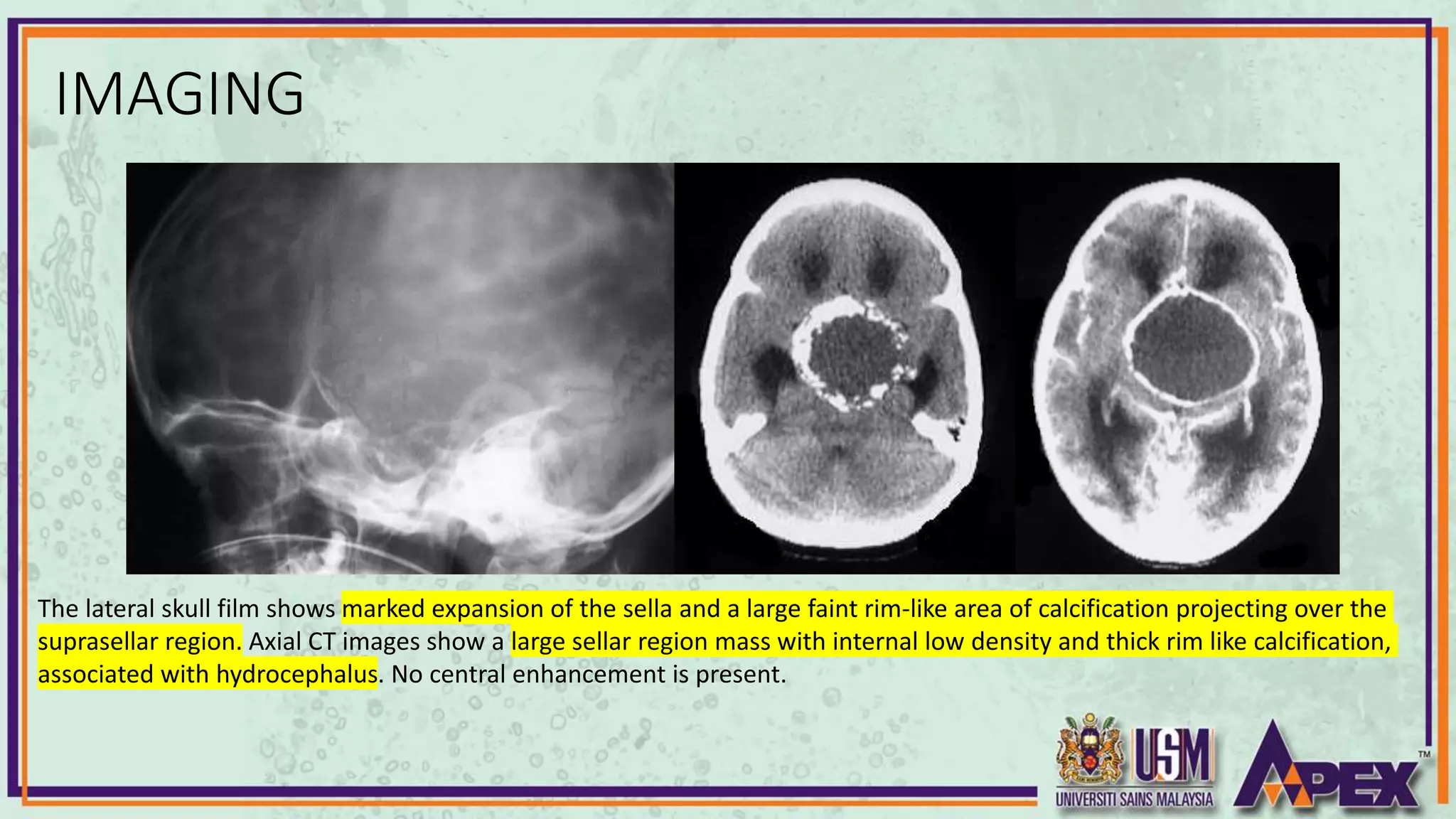 Sellar Region Tumors.pptx