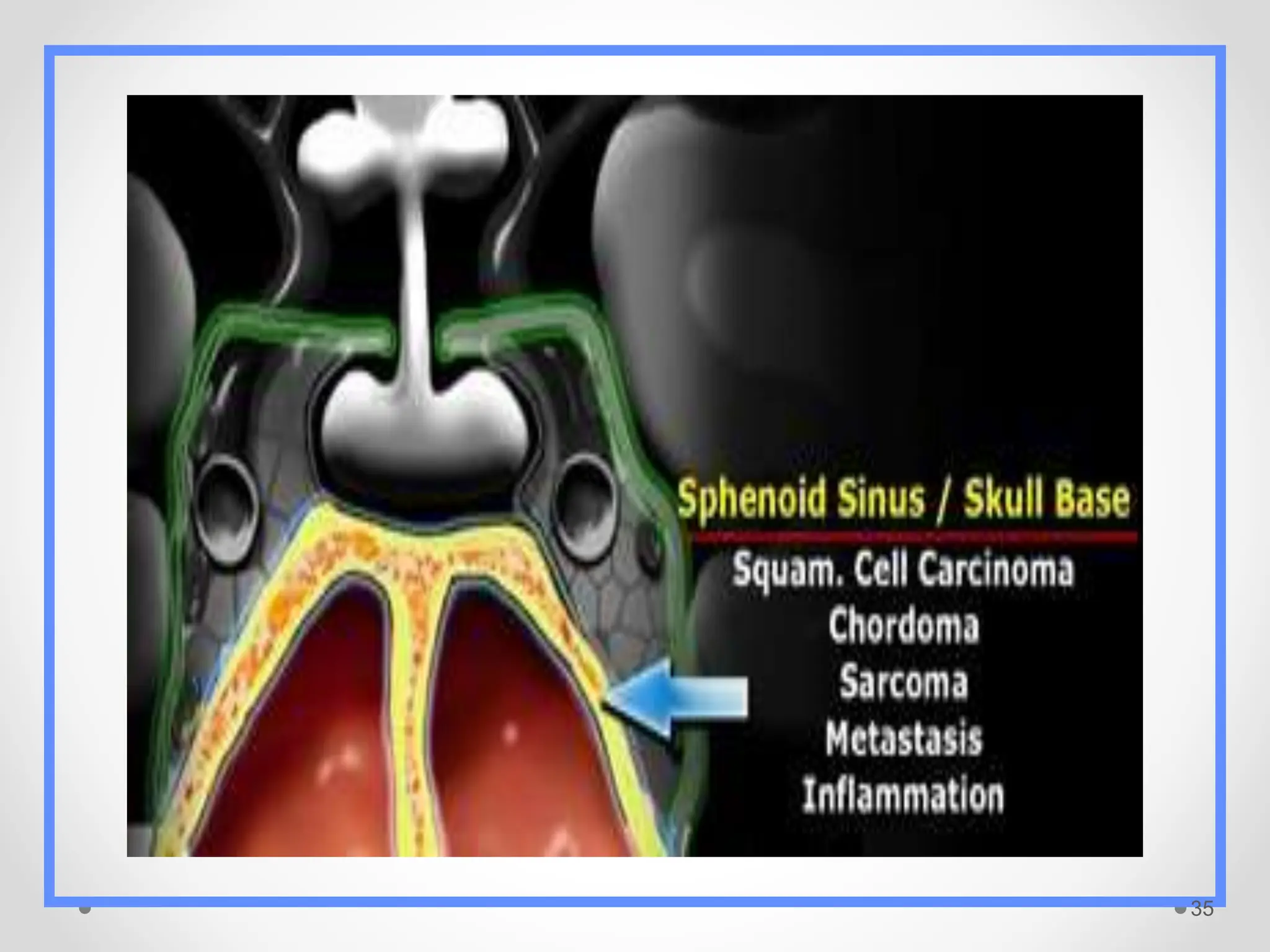 Sellar & Suprasellar mass by Deepak.pptx