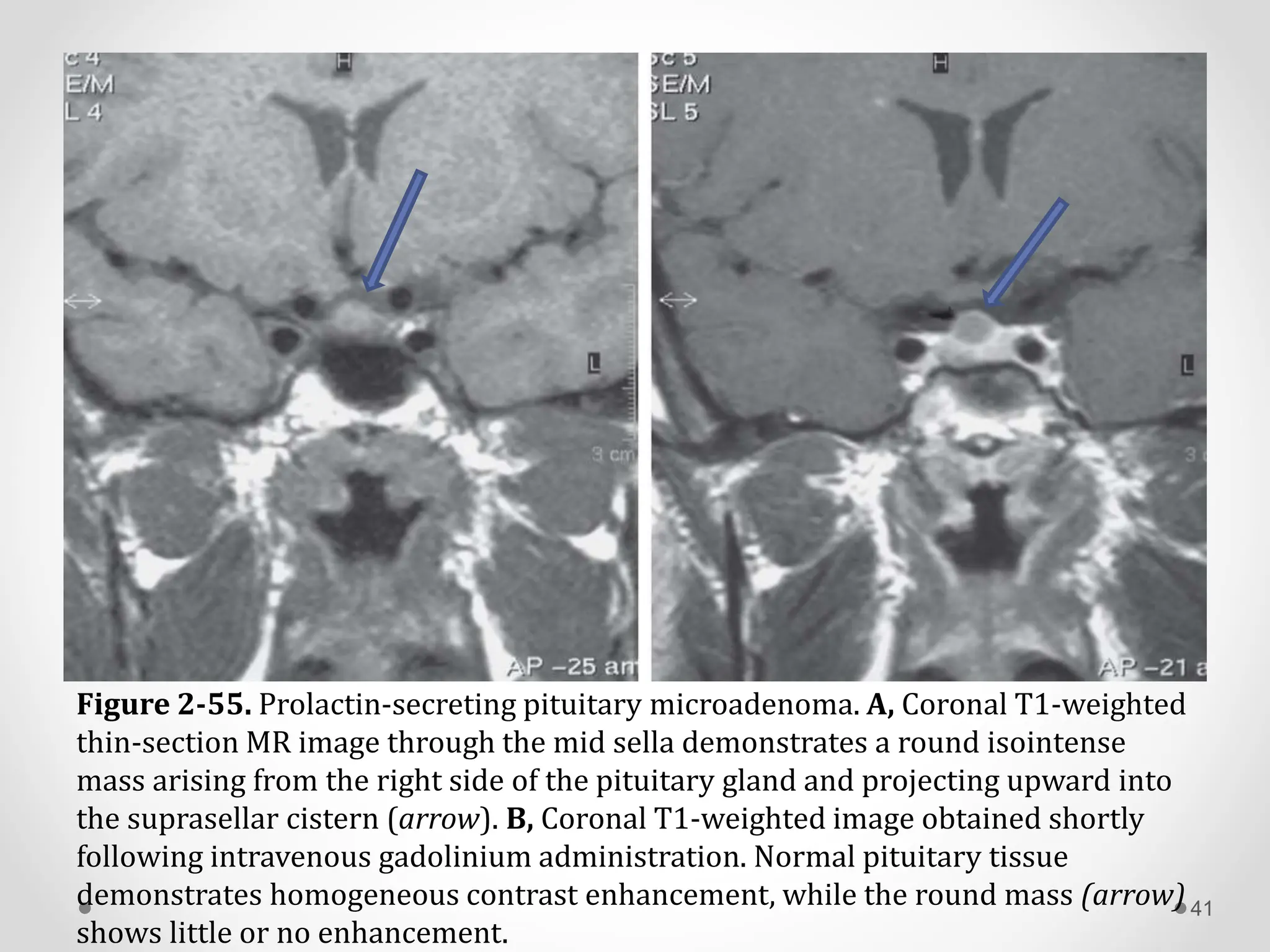Sellar & Suprasellar mass by Deepak.pptx