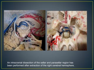 Sella supra sella anatomy | PPTX