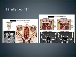 Sella supra sella anatomy | PPTX