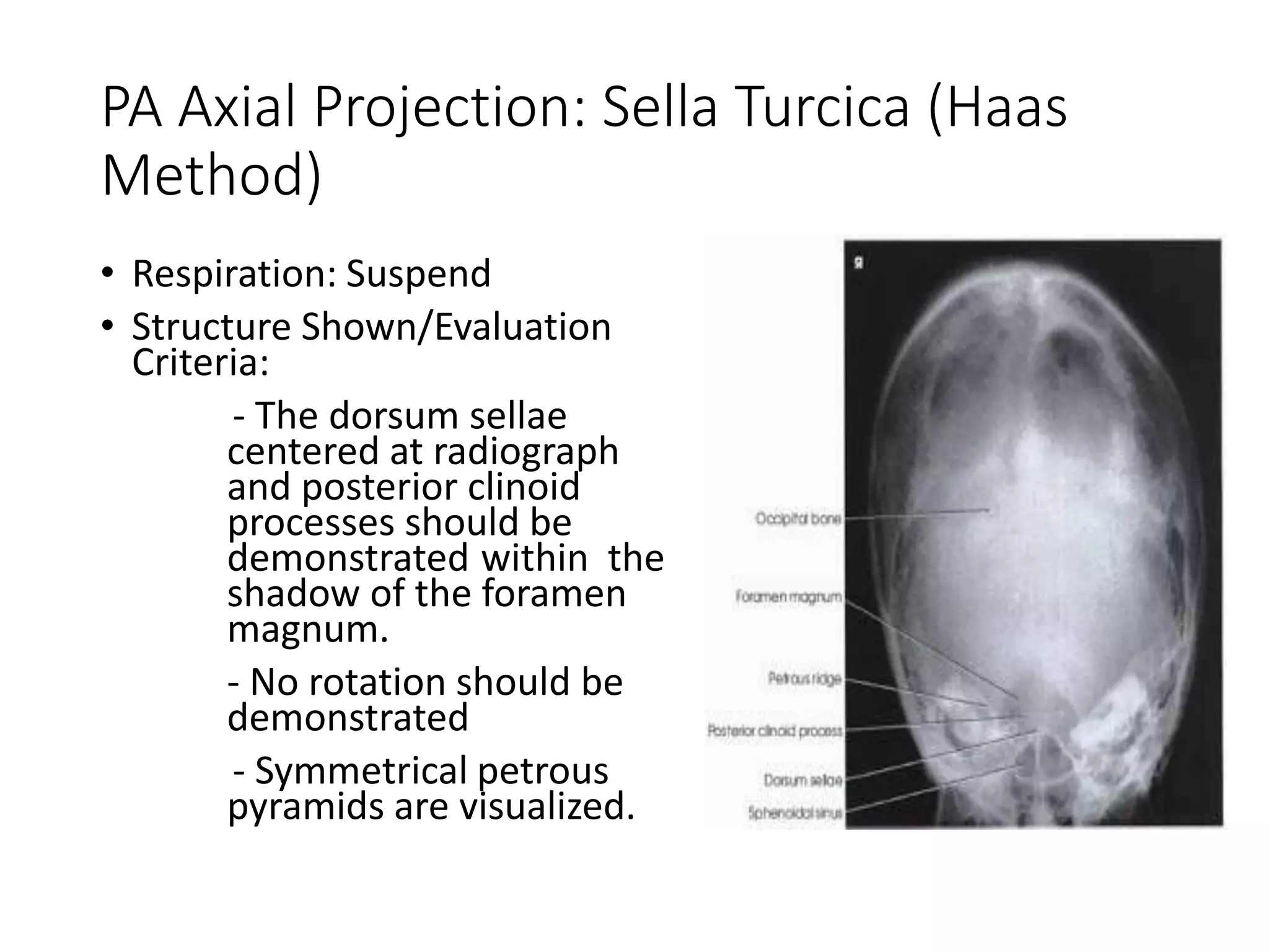Sella Turcica (RAD32) | PPTX | Bone and Joint Conditions | Diseases and ...