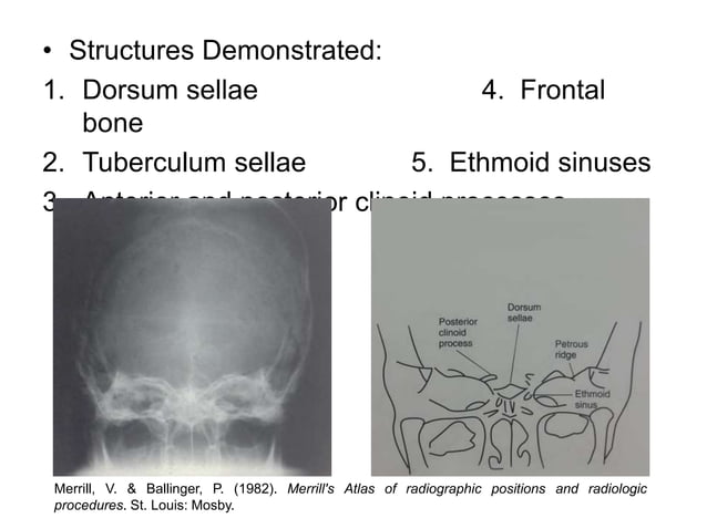 Sella Turcica (RAD32) | PPTX | Bone and Joint Conditions | Diseases and ...