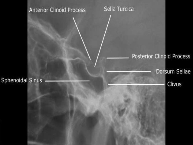 Sella Turcica (RAD32)