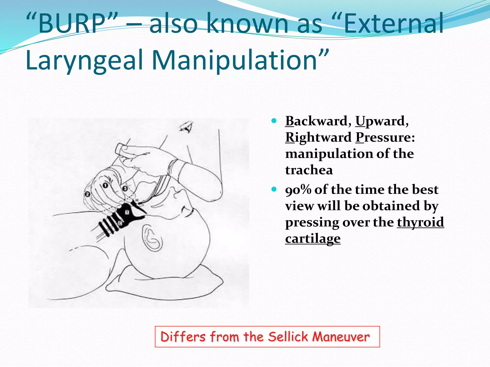 sellick maneuver, BURP , OELM | PPTX