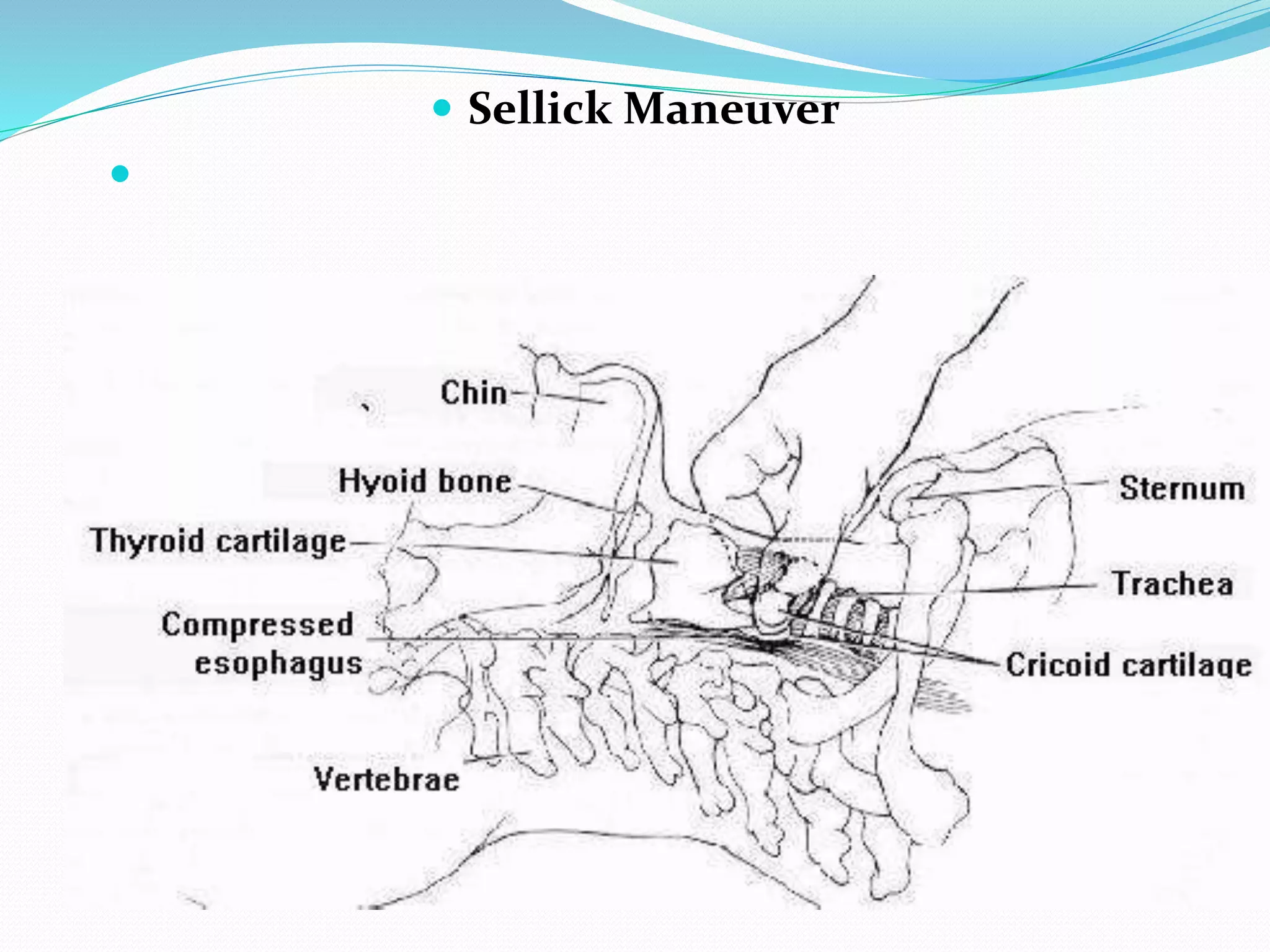sellick maneuver, BURP , OELM | PPTX