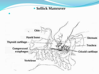 sellick maneuver, BURP , OELM | PPTX