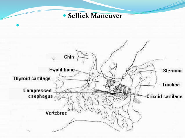 sellick maneuver, BURP , OELM | PPT