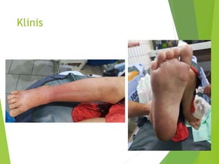 Selulitis | PPTX