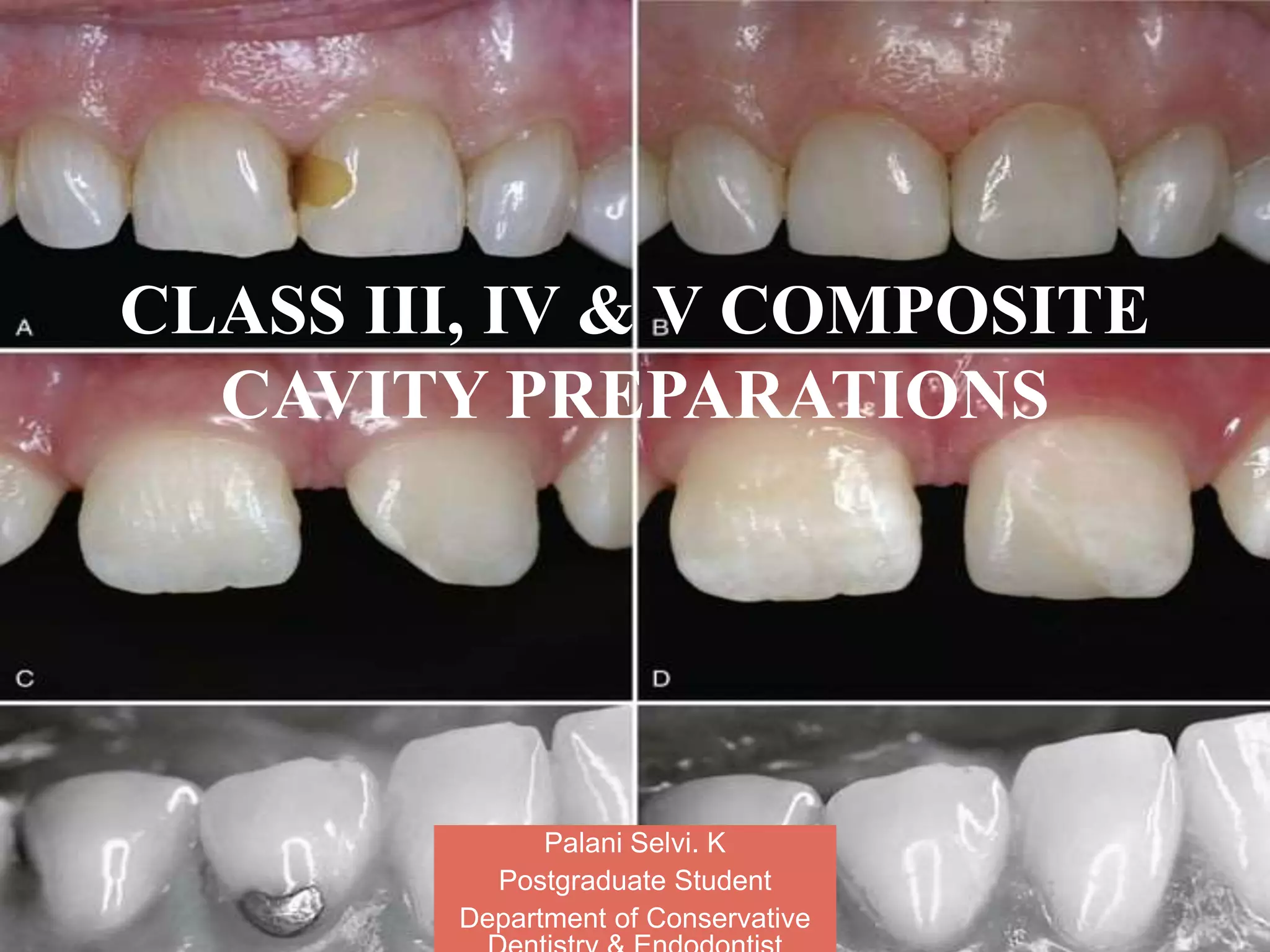 Class III, IV, V Cavity preparations for Composites- SELVI | PPTX
