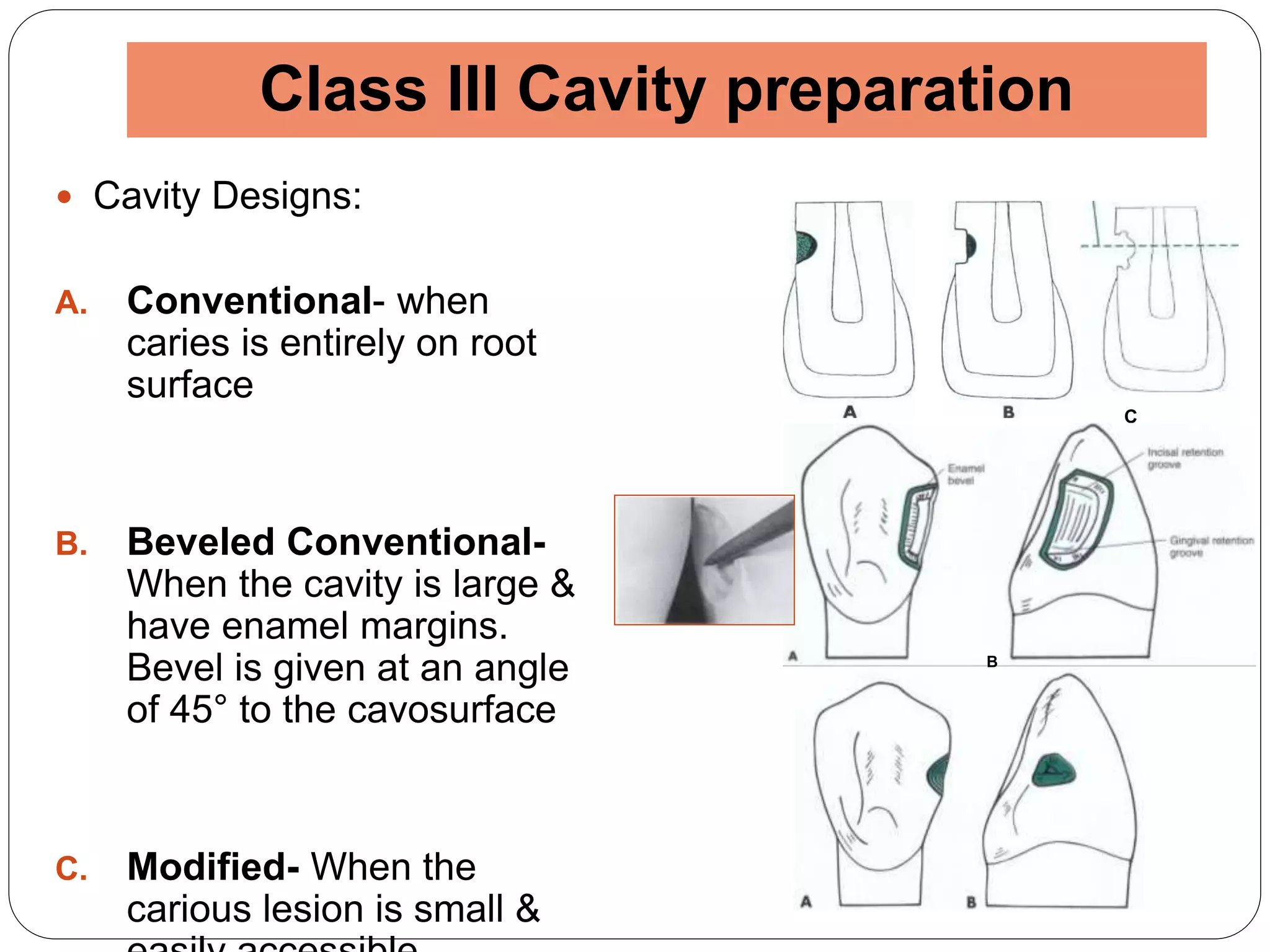 Class III, IV, V Cavity preparations for Composites- SELVI | PPTX