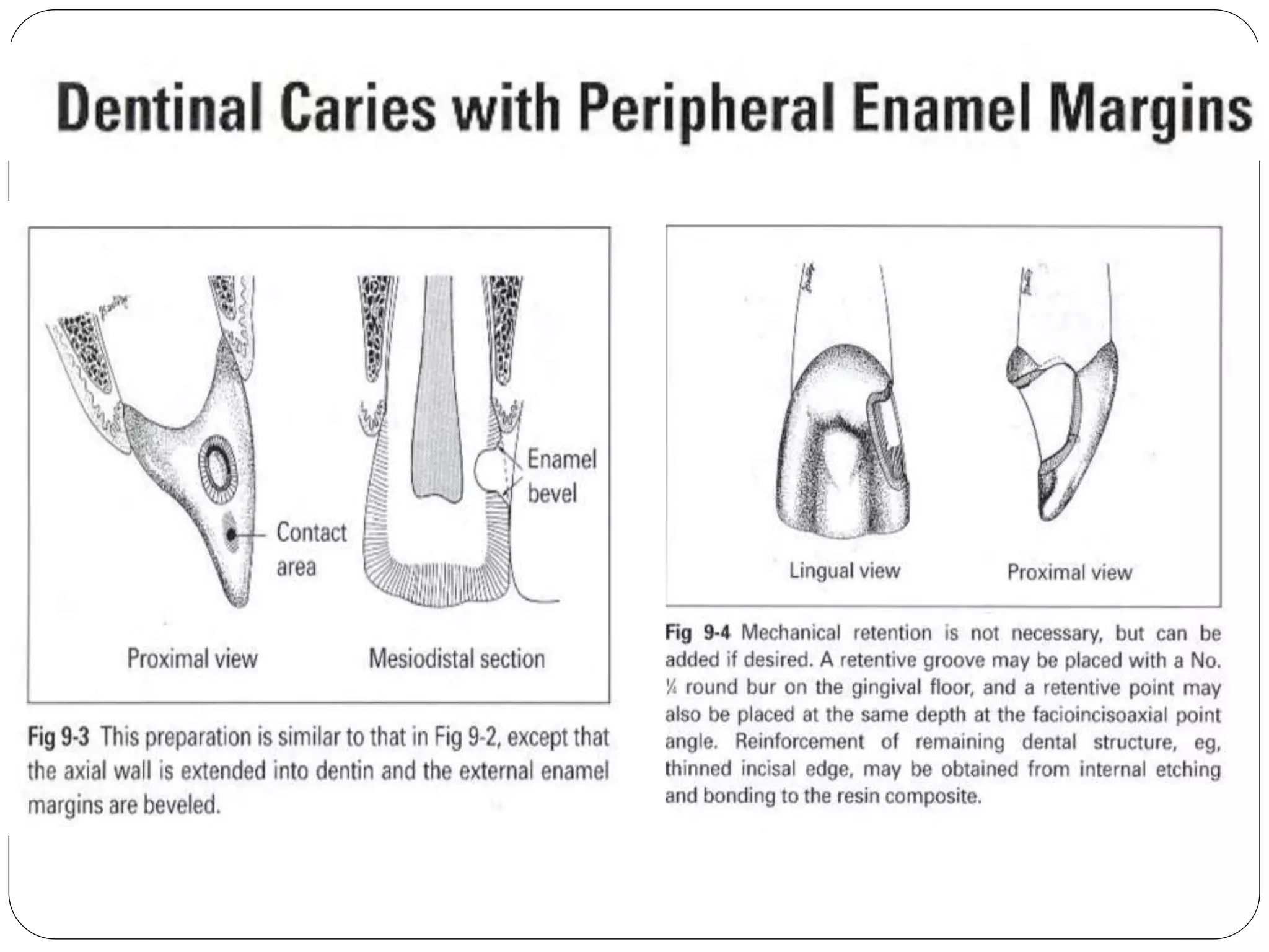 Class III, IV, V Cavity preparations for Composites- SELVI | PPTX