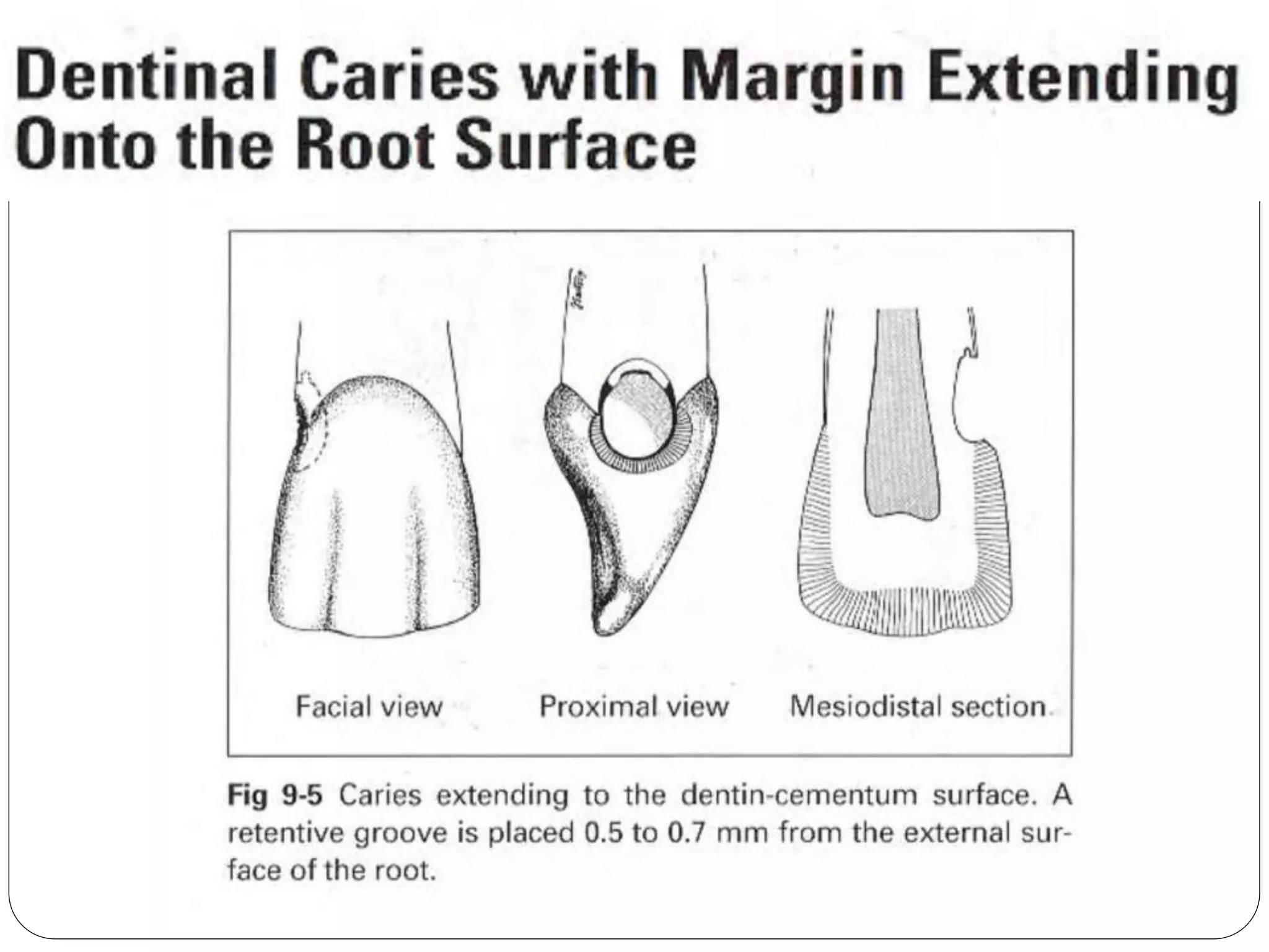 Class III, IV, V Cavity preparations for Composites- SELVI | PPTX