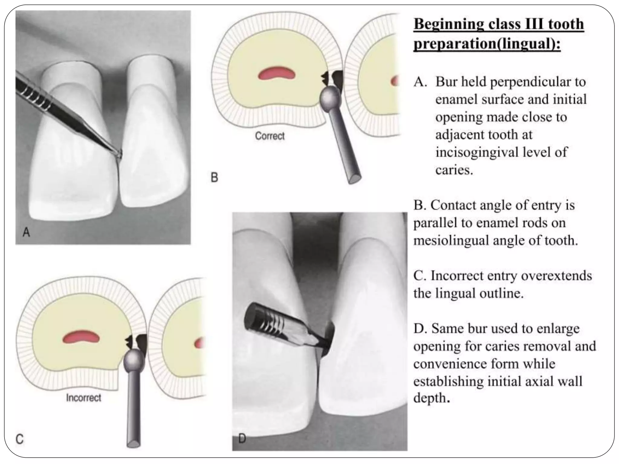 Class III, IV, V Cavity preparations for Composites- SELVI | PPTX