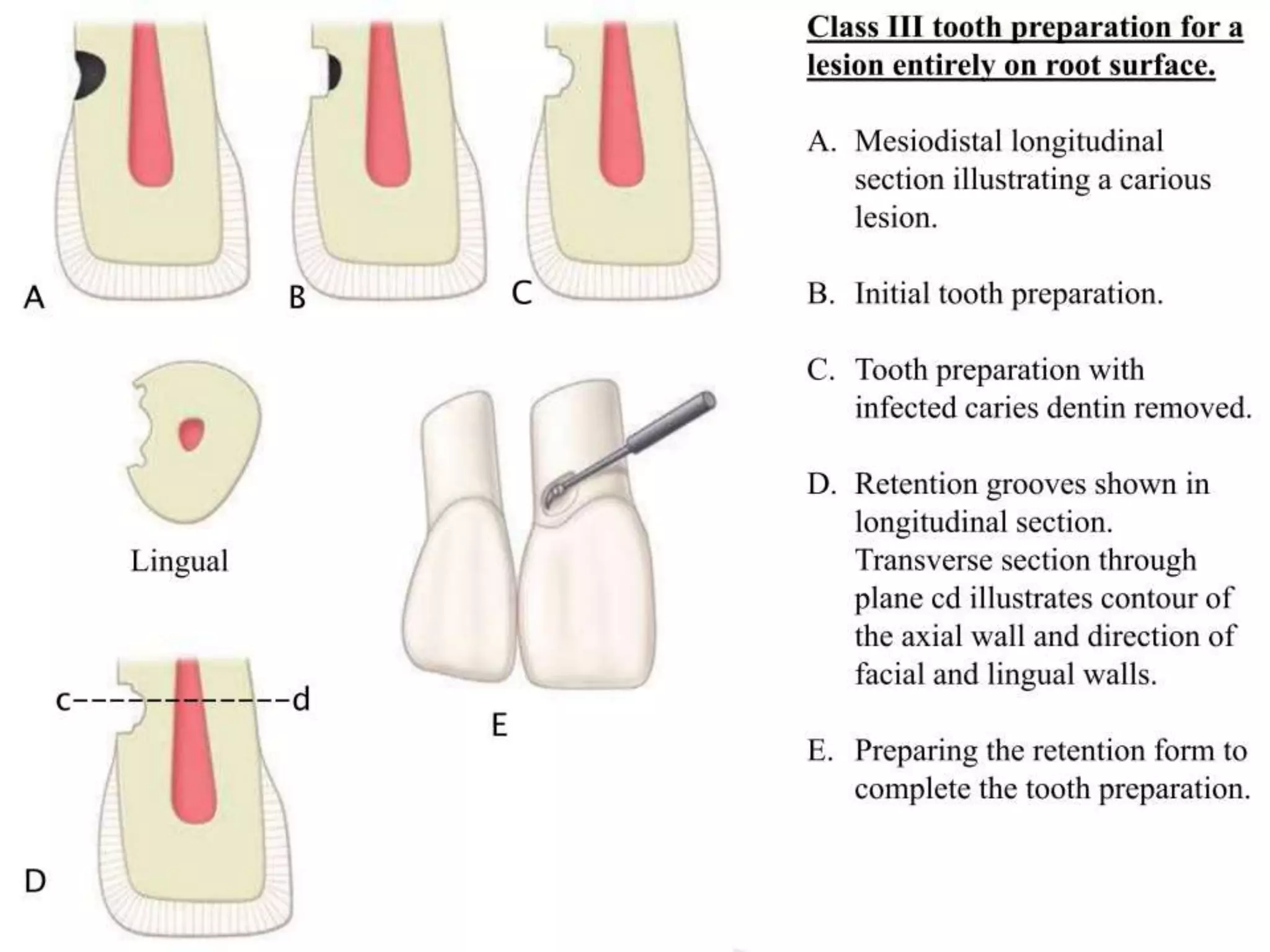 Class III, IV, V Cavity preparations for Composites- SELVI | PPTX