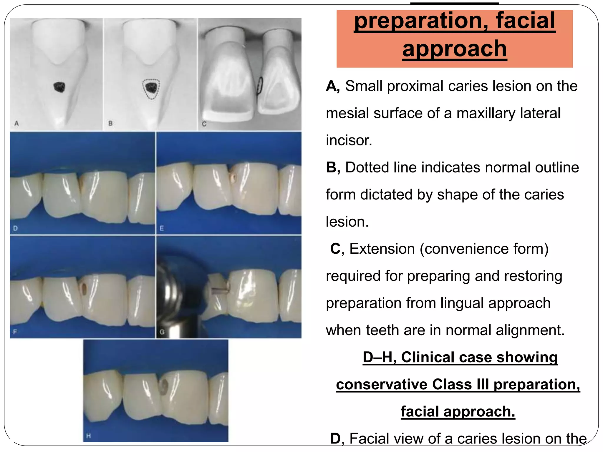 Class III, IV, V Cavity preparations for Composites- SELVI | PPTX