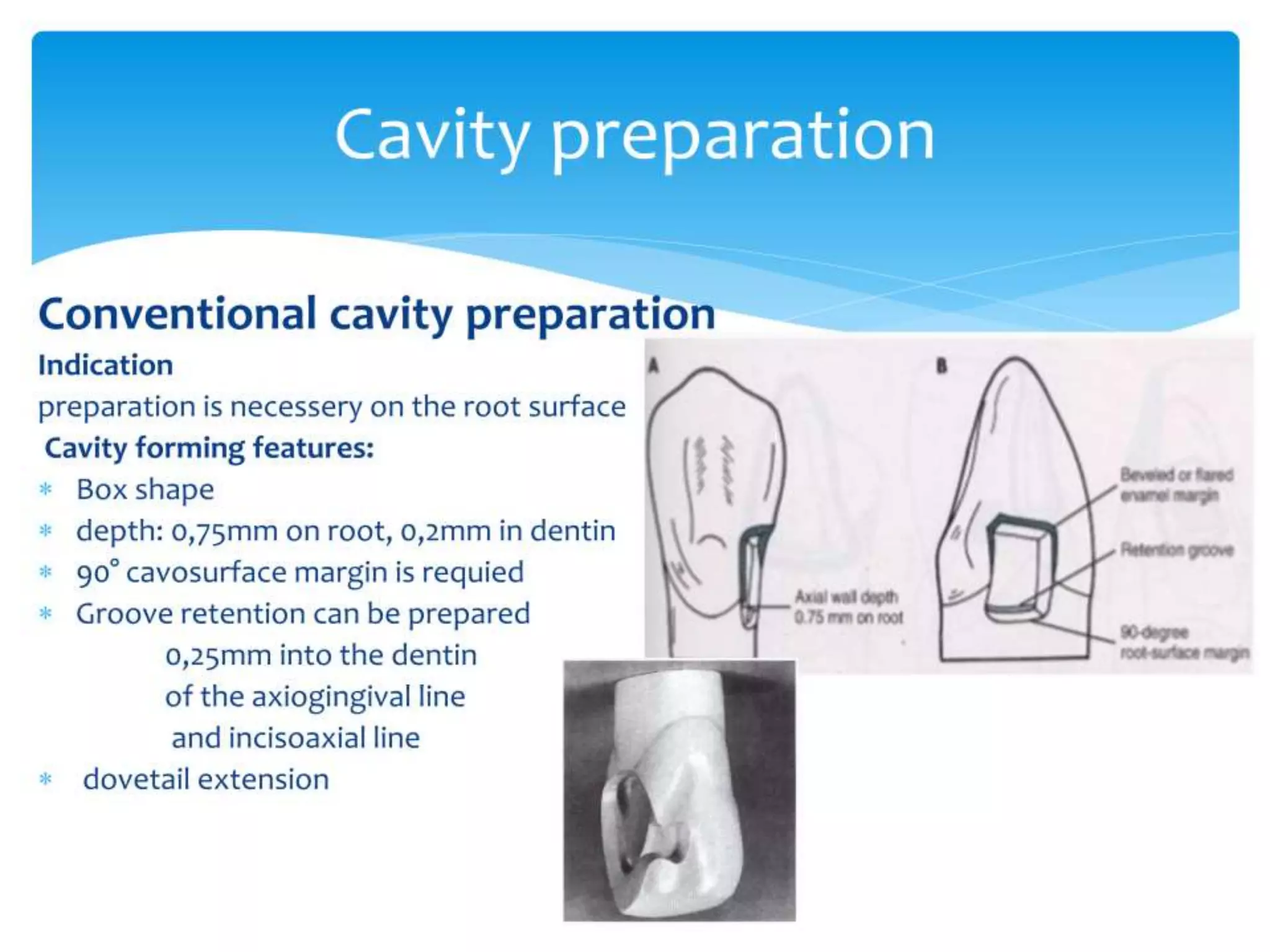 Class III, IV, V Cavity preparations for Composites- SELVI | PPTX