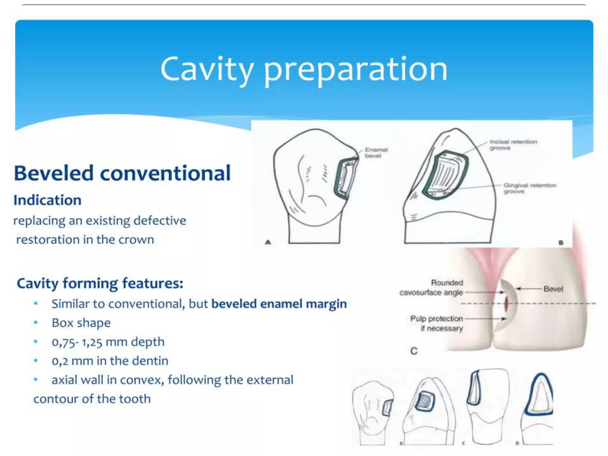 Class III, IV, V Cavity preparations for Composites- SELVI | PPTX