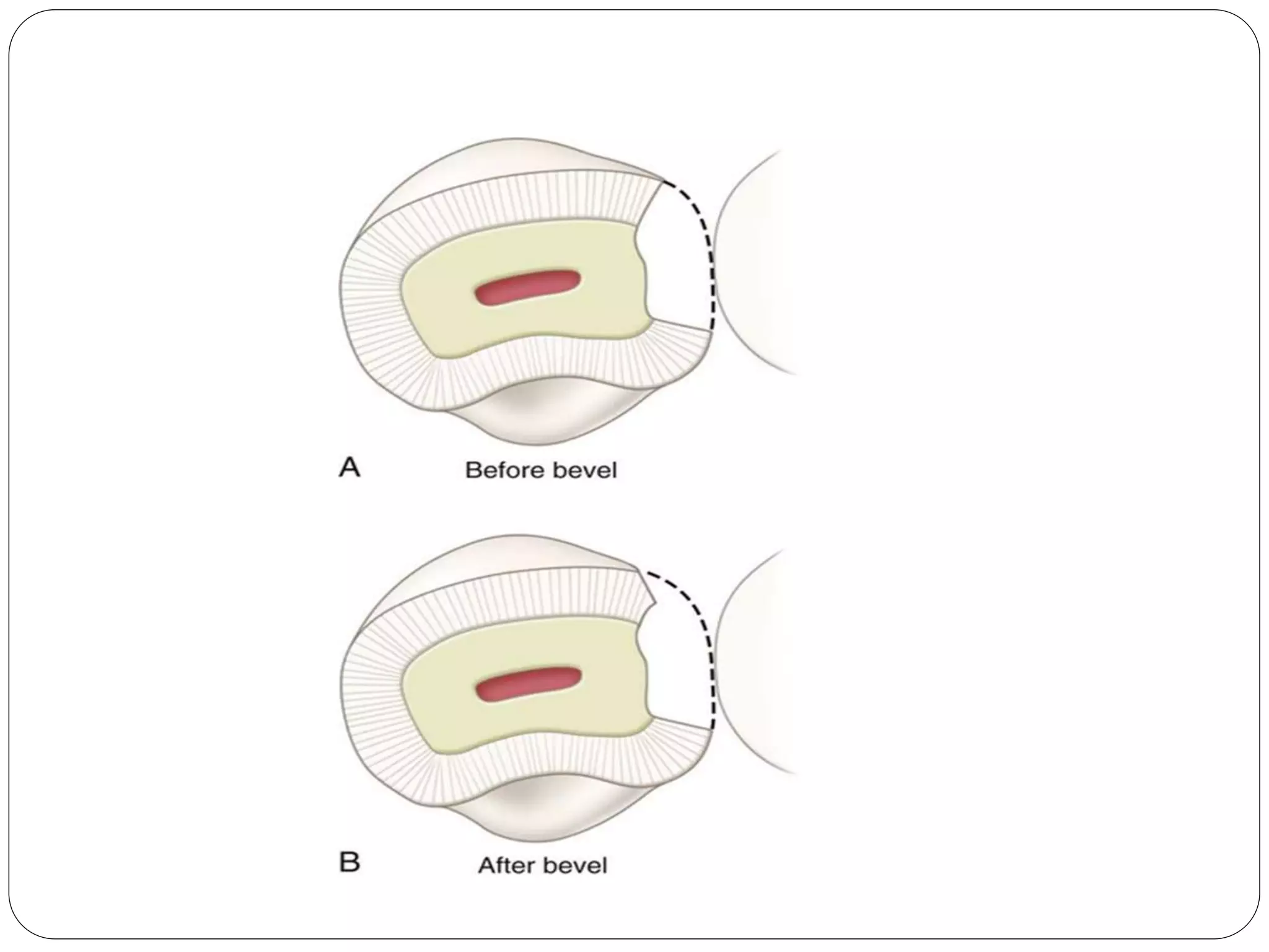 Class III, IV, V Cavity preparations for Composites- SELVI | PPTX