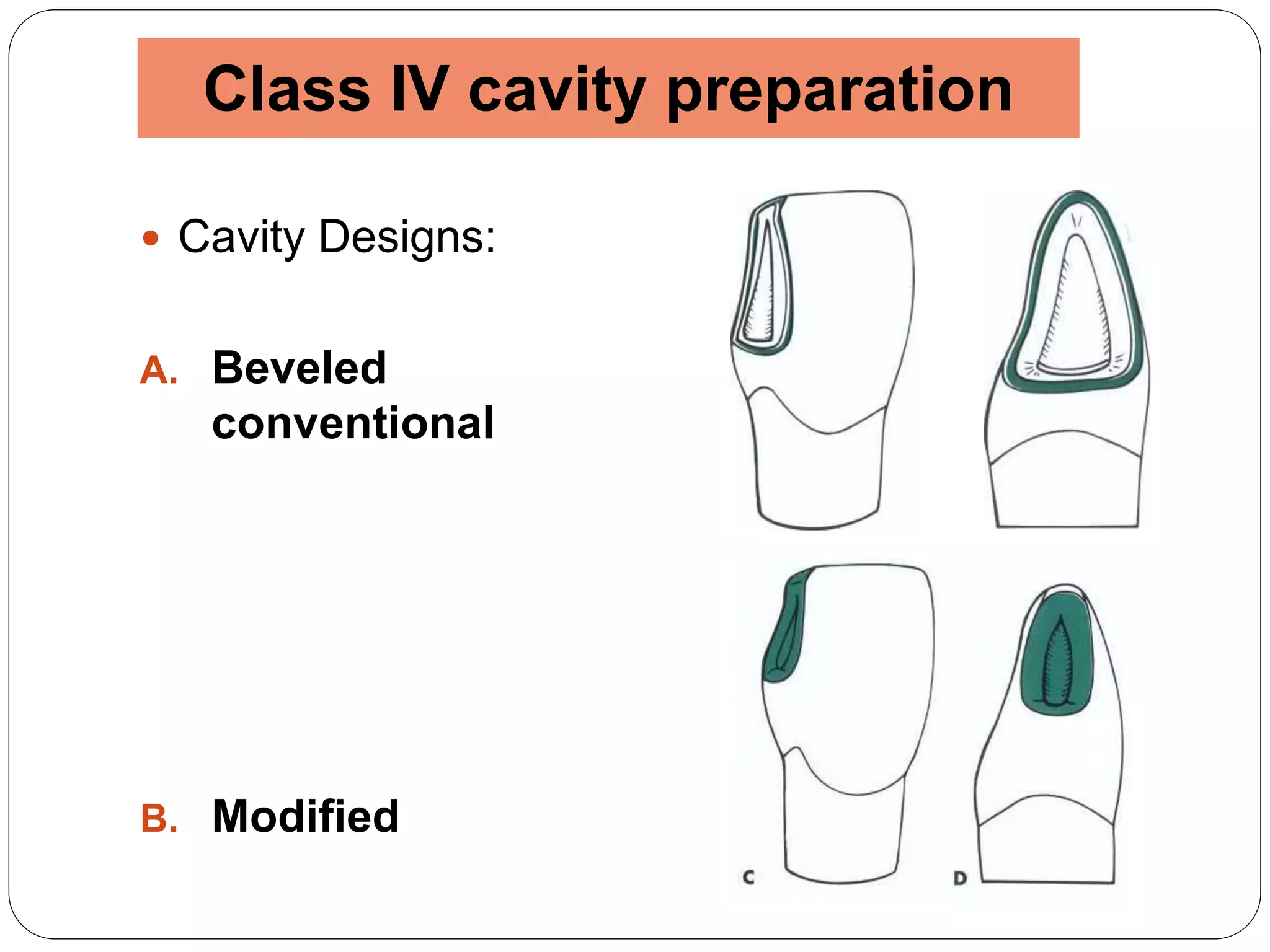 Class III, IV, V Cavity preparations for Composites- SELVI | PPTX