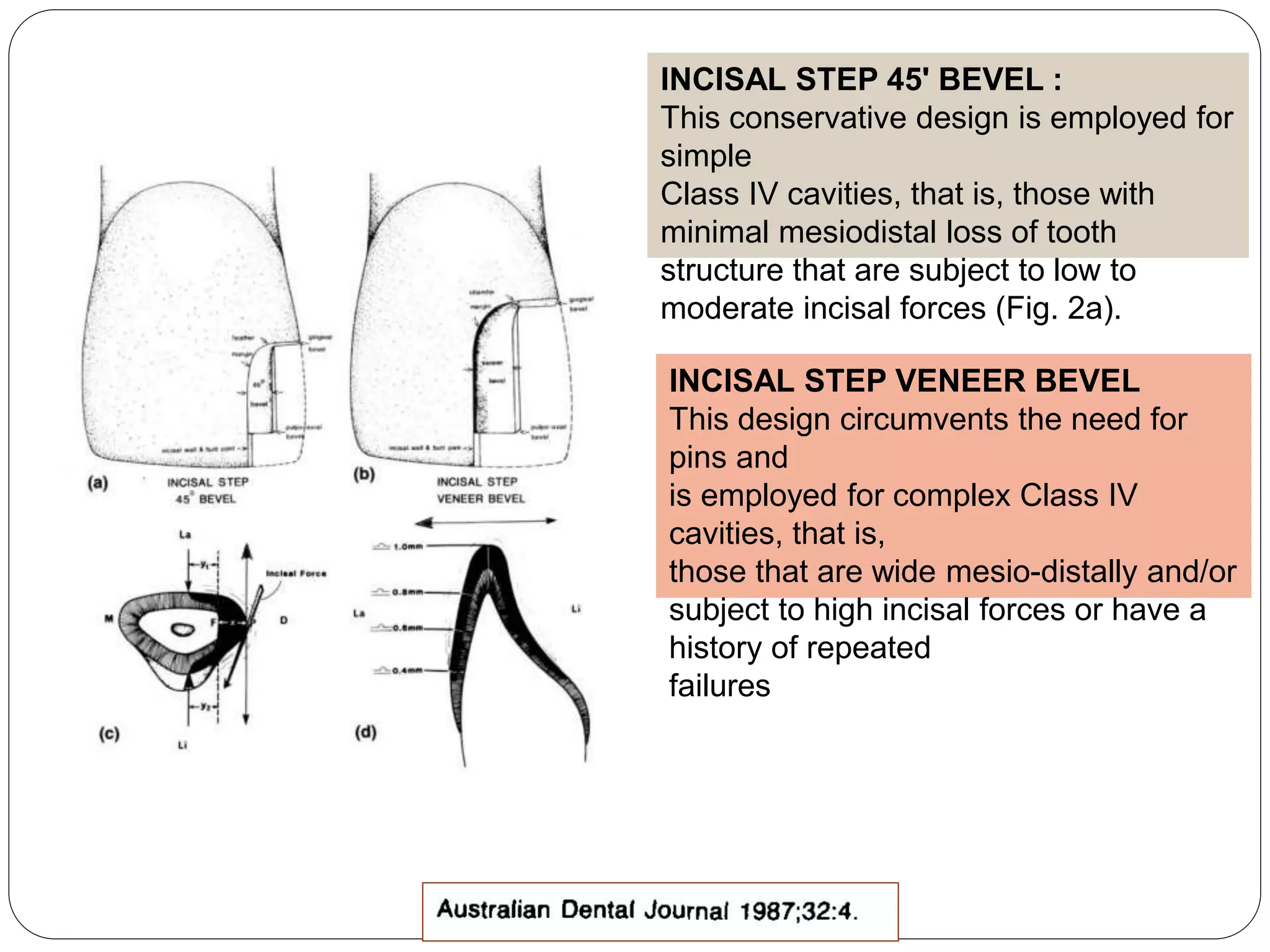 Class Iii Iv V Cavity Preparations For Composites Selvi Pptx