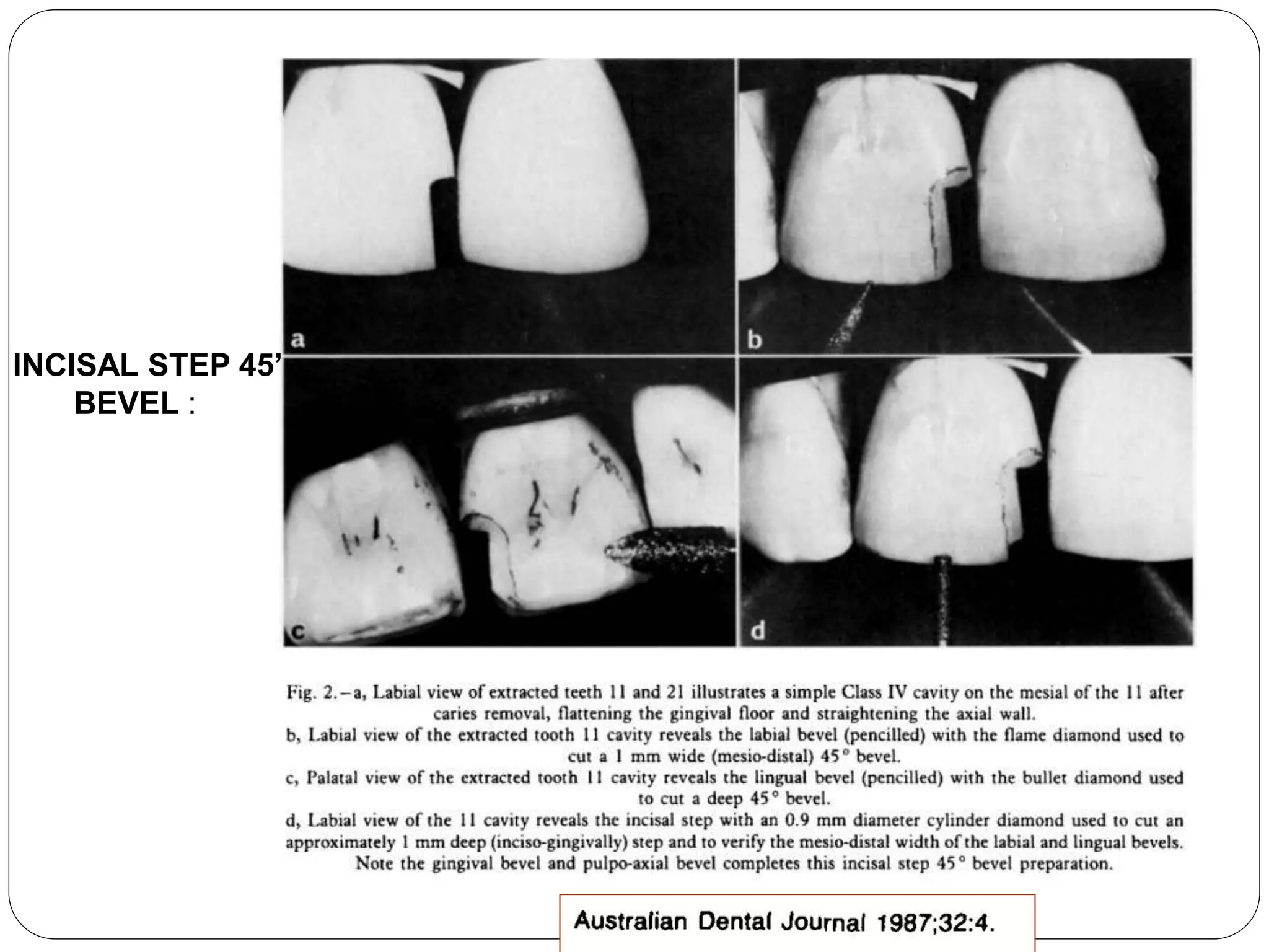 Class III, IV, V Cavity preparations for Composites- SELVI | PPTX