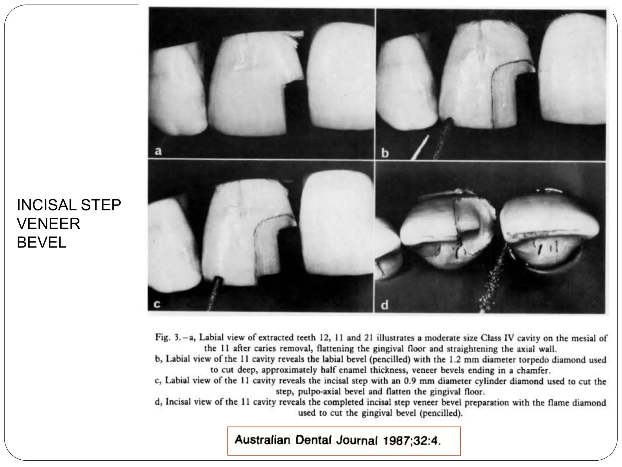 Class III, IV, V Cavity preparations for Composites- SELVI | PPTX