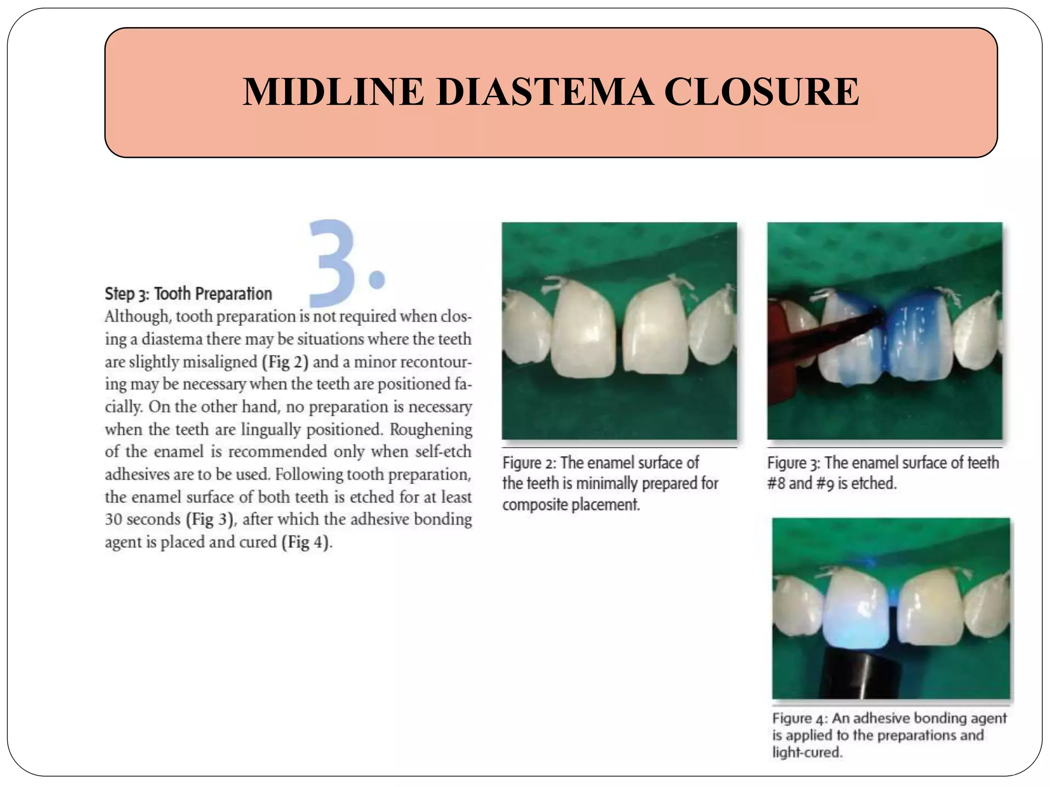 Class Iii Iv V Cavity Preparations For Composites Selvi Pptx
