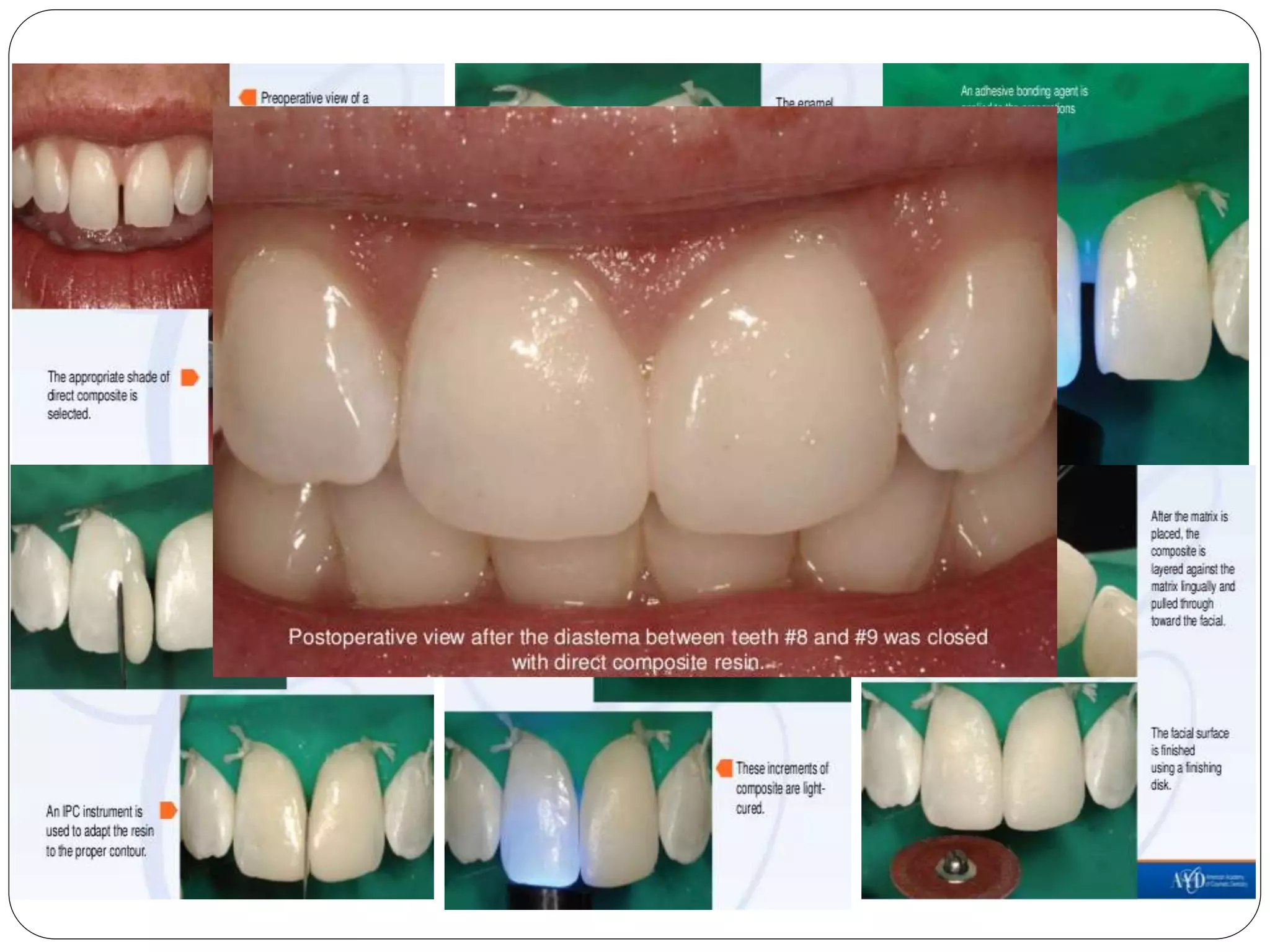 Class III, IV, V Cavity preparations for Composites- SELVI | PPTX