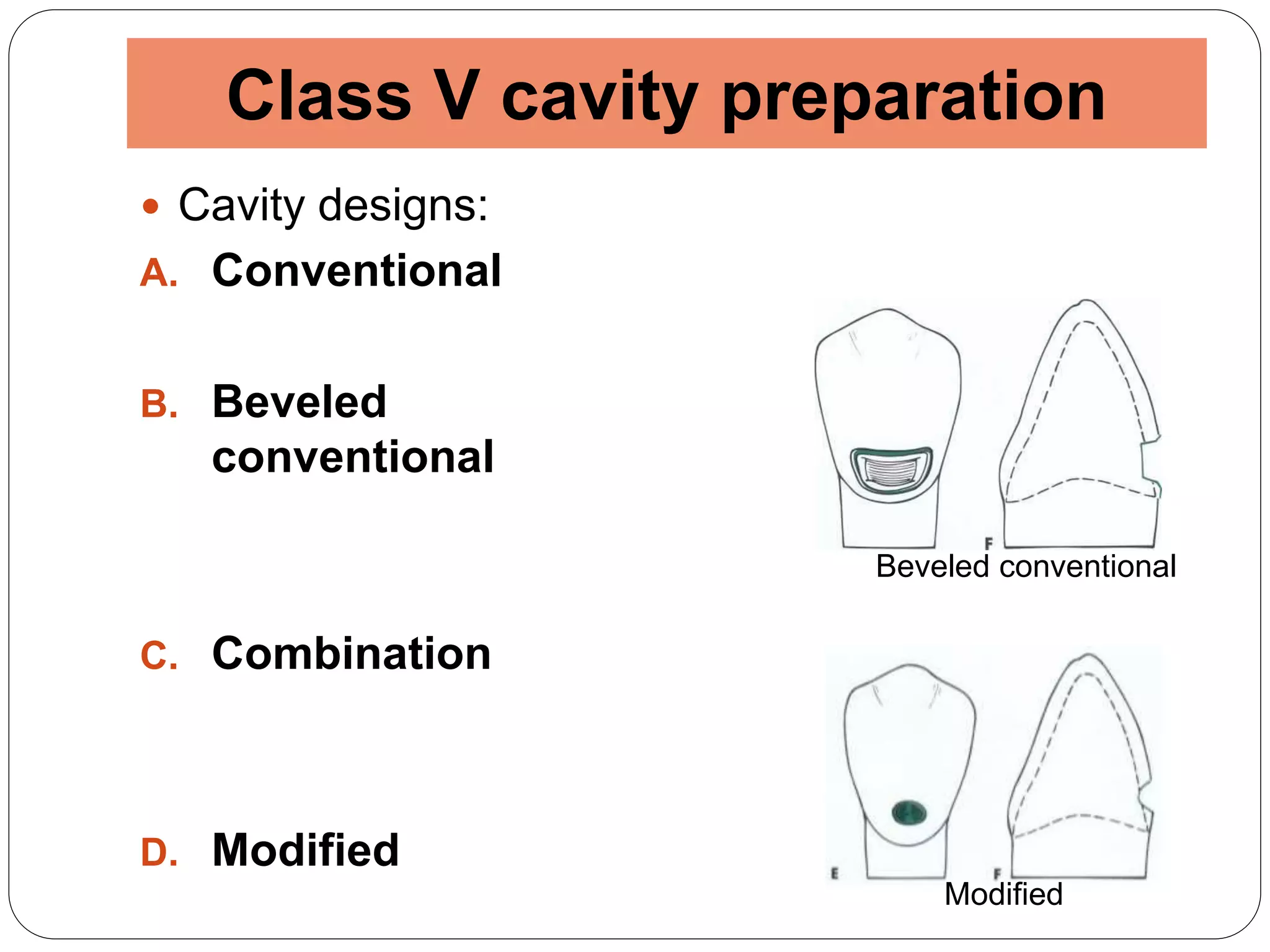 Class III, IV, V Cavity preparations for Composites- SELVI | PPTX