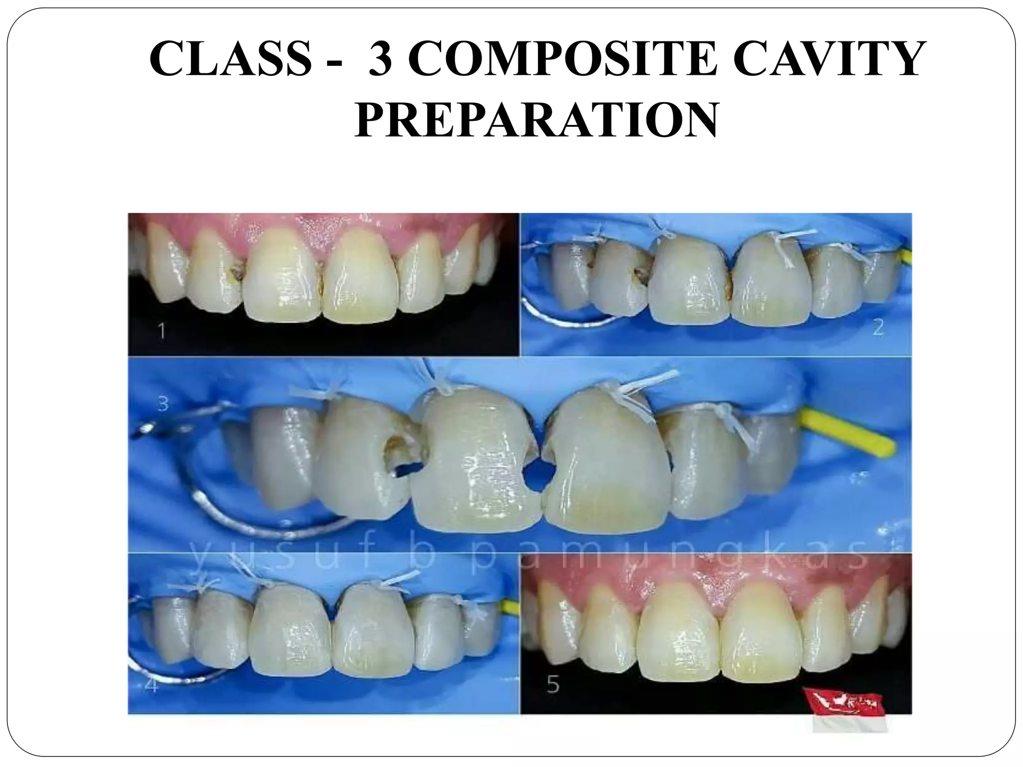 Class III, IV, V Cavity preparations for Composites- SELVI | PPTX