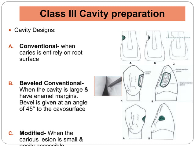 Class III, IV, V Cavity preparations for Composites- SELVI | PPTX