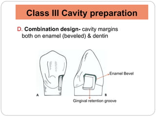 Class III, IV, V Cavity preparations for Composites- SELVI | PPTX