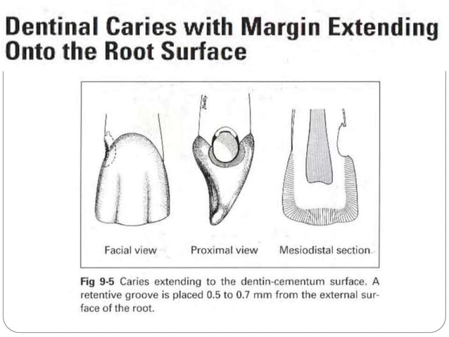 Class III, IV, V Cavity preparations for Composites- SELVI | PPTX