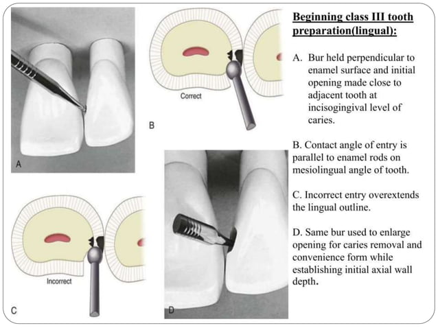Class III, IV, V Cavity preparations for Composites- SELVI | PPTX