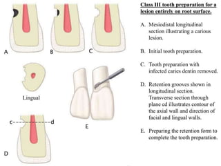 Class III, IV, V Cavity preparations for Composites- SELVI | PPTX