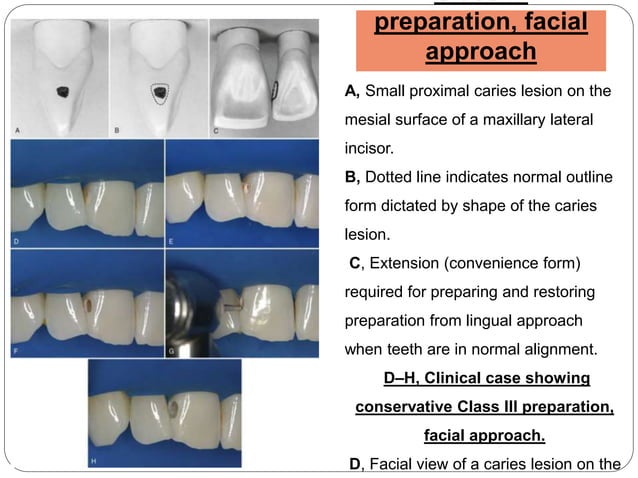 Class III, IV, V Cavity preparations for Composites- SELVI | PPTX