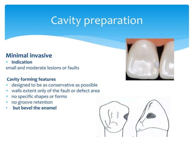 Class III, IV, V Cavity preparations for Composites- SELVI | PPTX