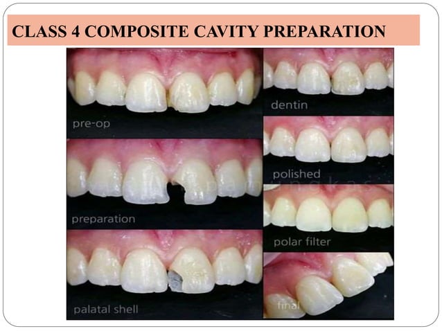 Class III, IV, V Cavity preparations for Composites- SELVI | PPTX