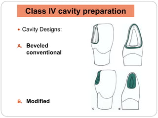 Class III, IV, V Cavity preparations for Composites- SELVI | PPTX