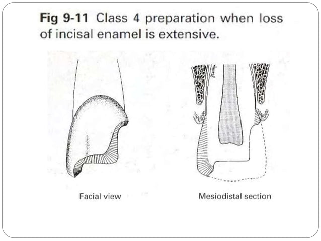 Class III, IV, V Cavity preparations for Composites- SELVI | PPTX