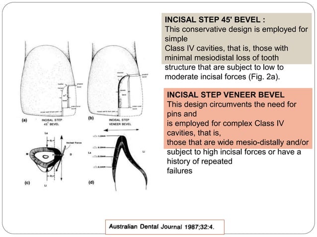 Class III, IV, V Cavity preparations for Composites- SELVI | PPTX