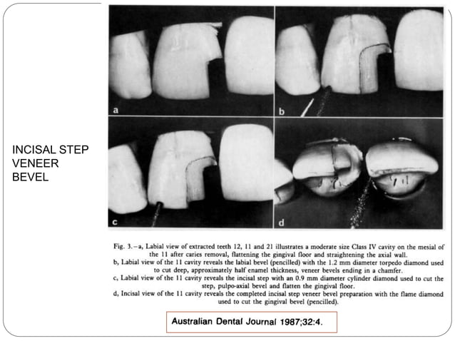 Class III, IV, V Cavity preparations for Composites- SELVI | PPTX